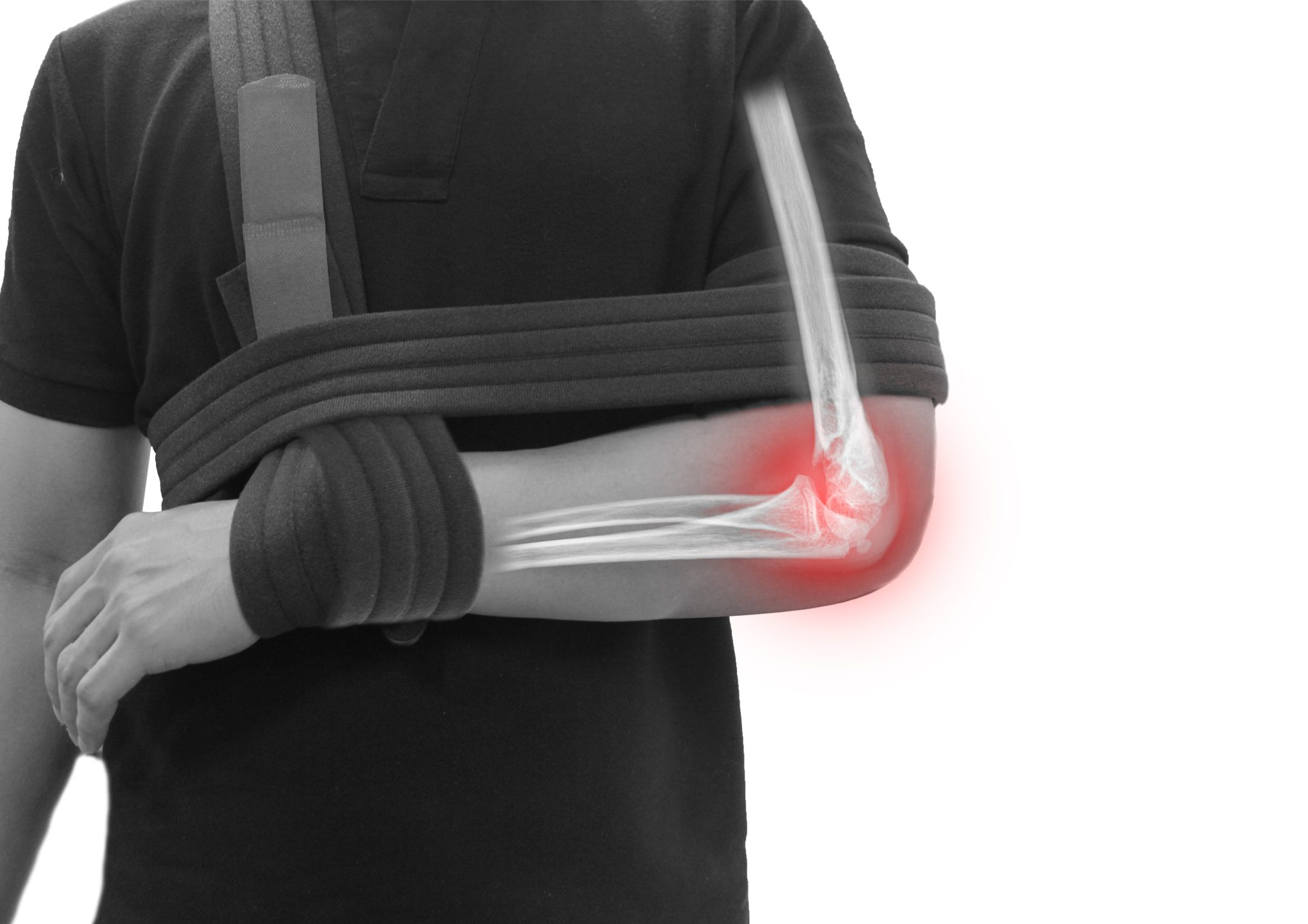 Elbow Fractures – Katranji Hand Center